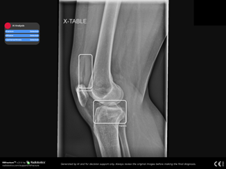 Detection of MSK Pathologies | RBfracture